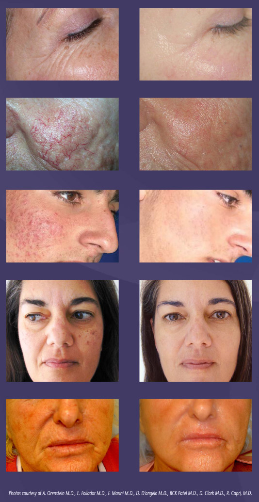 PhotoFacial IPL – Intense Pulsed Light – Laser Looks – Leamington Laser ...