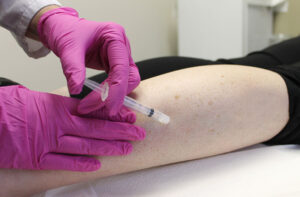 Vein Therapy – Laser Looks – Leamington Laser Hair Removal, Skin ...